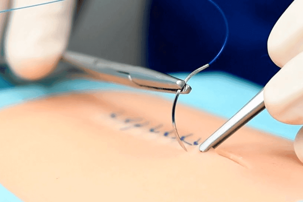 Tipos De Suturas Cirúrgicas - RETOEDU